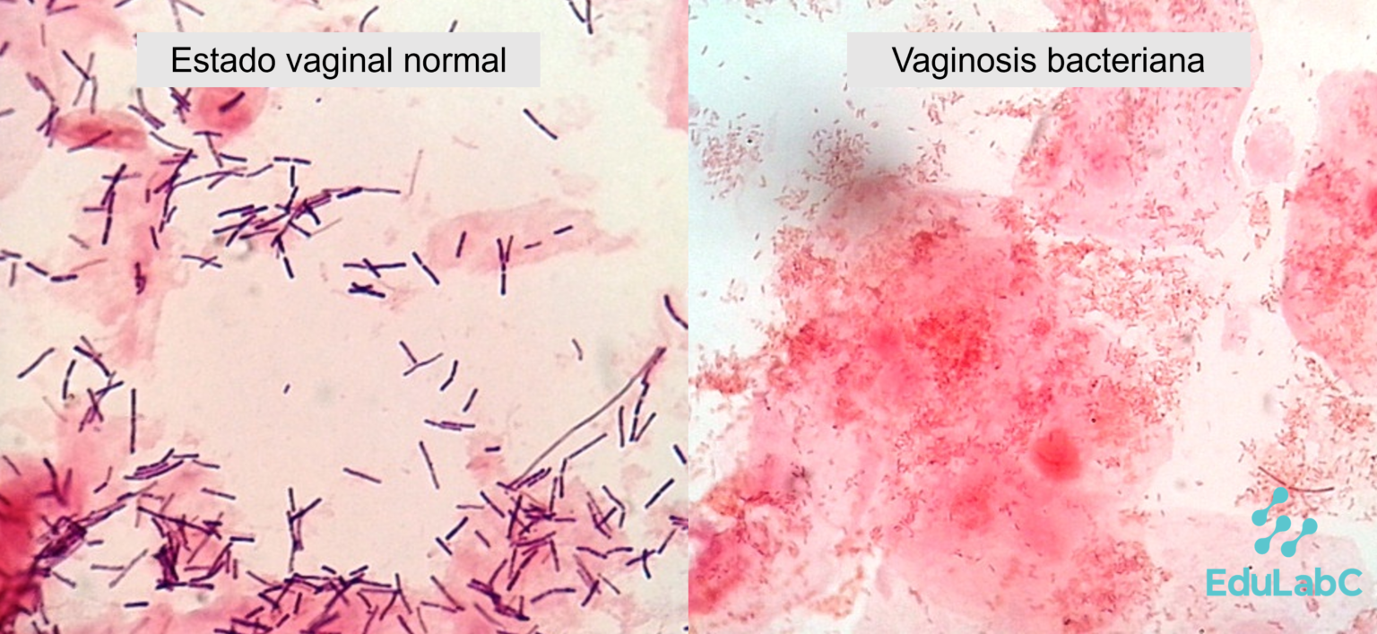 Vaginosis bacteriana - Edulabc